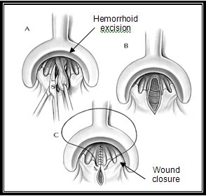 Hemorrhoidectomy | UCSF Department of Surgery