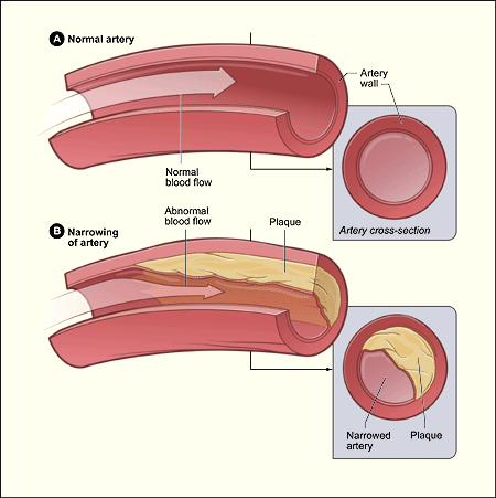 Coronary Artery Disease | UCSF Department of Surgery